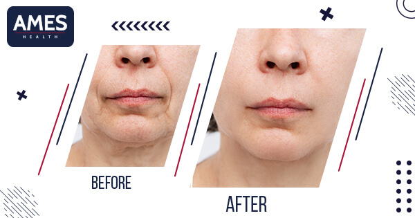 Face Lift with Focus Ultrasound Hifu Method - Skin Lift - Non-Surgical ...