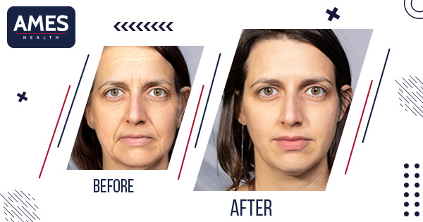 Medical Aesthetic - Medical Aesthetics Applications - Ames Health