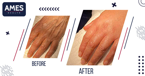 Fat Injection Operations - Fat Injection to the Face - Body Aesthetics ...