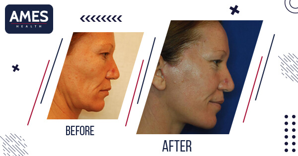 Facial Aesthetics - Facial Aesthetics Methods - Plastic Surgery - Ames ...